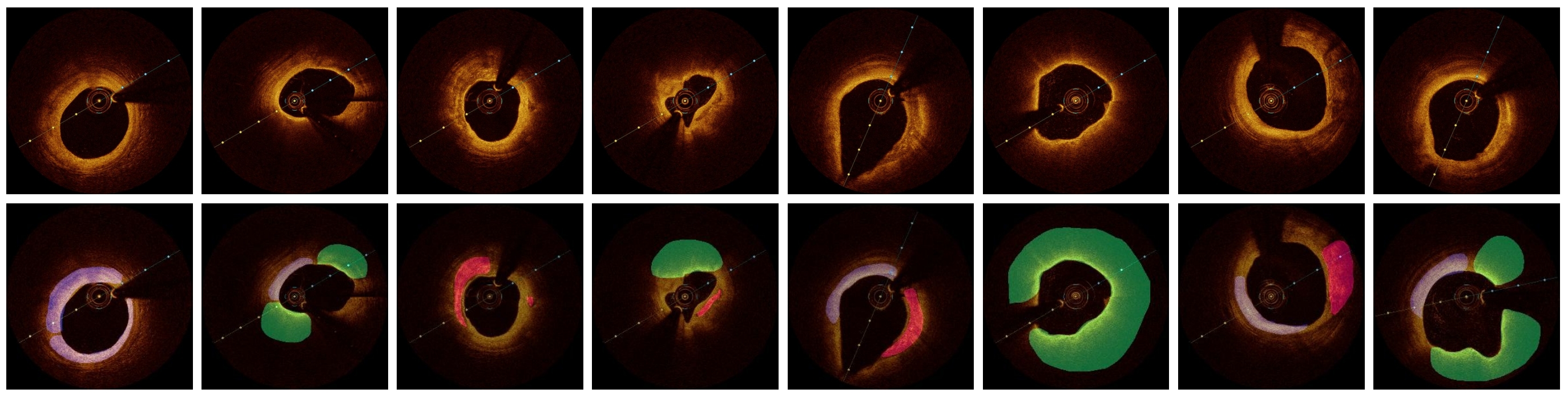 IVOCT-Lesion-Segmentation-Detection-Project IVOCT-Lesion-Segmentation-Detection-Project